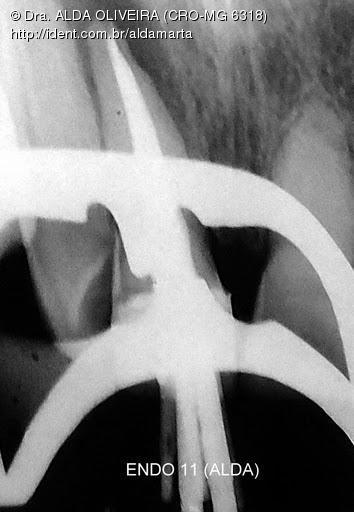 Traumatismo Dentário Caso clínico iDent