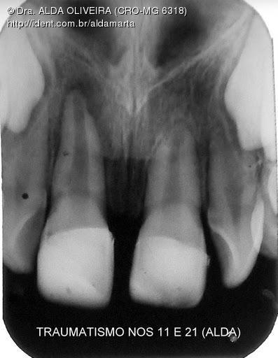Traumatismo Dentário Caso clínico iDent