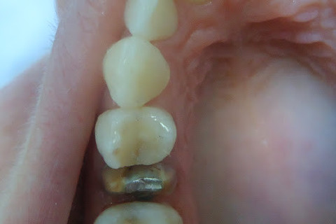 Exérese de 3º Molar Semi-Incluso, Caso clínico | iDent