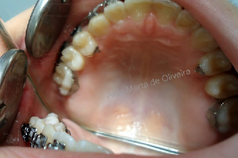 Exérese de 3º Molar Semi-Incluso, Caso clínico | iDent