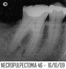 Necropulpectomia do 46, Caso clínico | iDent