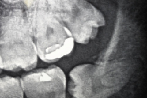 Exodontia do Dente 48 com Inclusão Mesio-Angular e Impactado no 47 ...