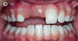 Ulectomia, Artigo | iDent