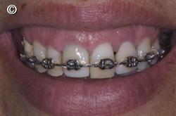 Exodontia Minimamente Traumática Através do Benex Root Extractor System ...