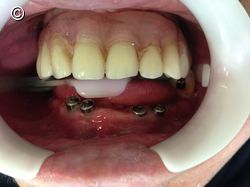 Prótese Fixa Sobre Implantes, Caso clínico | iDent