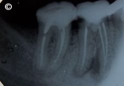 Retratamento Endodôntico do Dente 46 Usando Sistema Rotatório e Limas ...