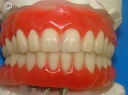 Protese ``protocolo de Branemark``bi-Maxilar, Caso clínico | iDent