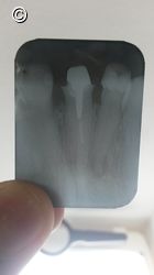 Coroa Cerômero 2.1, Caso clínico | iDent