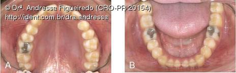 A Síndrome de Turner em Odontologia, Artigo | iDent