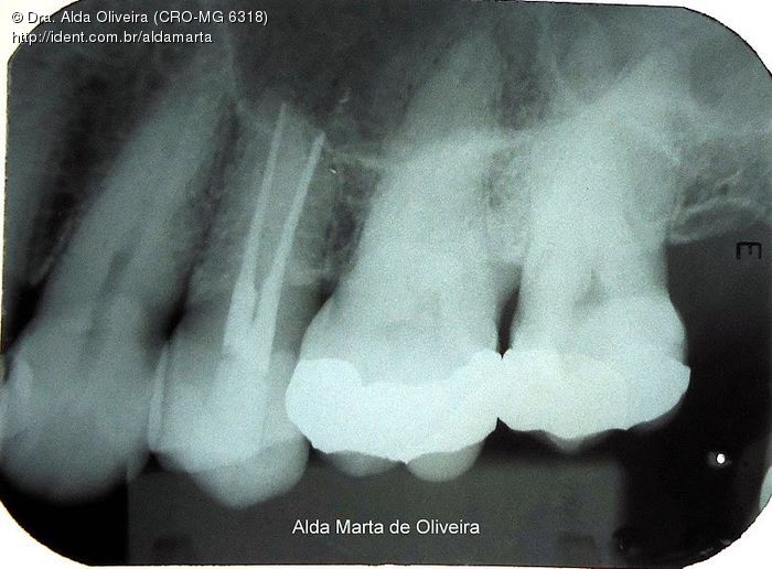 Pulpite Irreversível Após Substituição de Amálgama por Resina., Caso ...