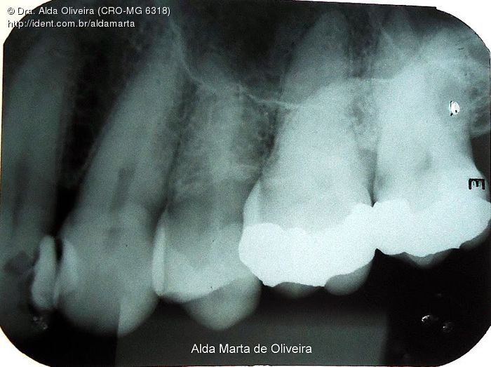 Pulpite Irreversível Após Substituição de Amálgama por Resina., Caso ...