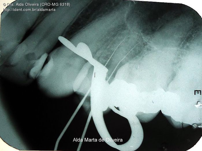 Pulpite Irreversível Após Substituição de Amálgama por Resina., Caso ...