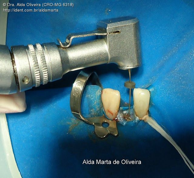 Odontogeriatria: Gengivectomia, Endo do 41 Calcificado, Pino em Fibra ...
