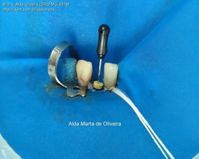 Odontogeriatria: Gengivectomia, Endo do 41 Calcificado, Pino em Fibra ...