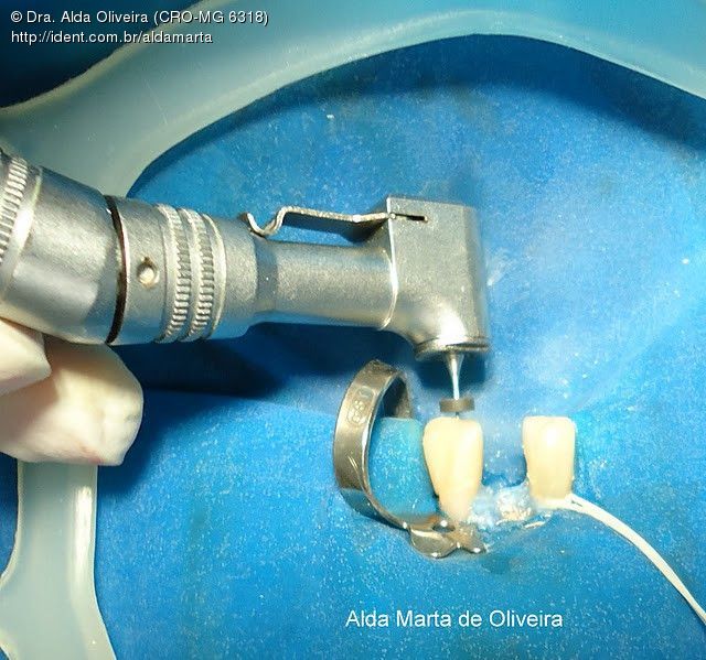 Odontogeriatria: Gengivectomia, Endo do 41 Calcificado, Pino em Fibra ...