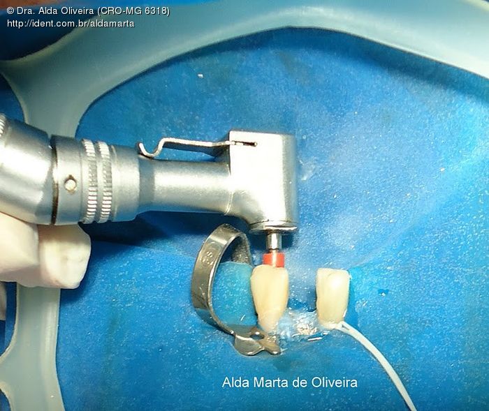 Odontogeriatria: Gengivectomia, Endo do 41 Calcificado, Pino em Fibra ...