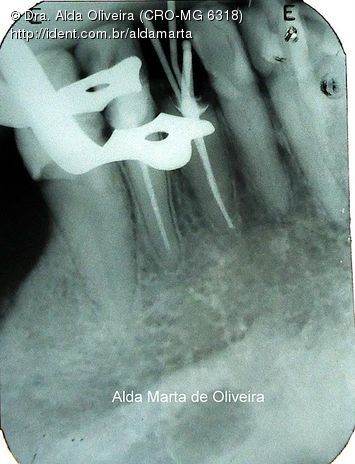 Odontogeriatria: Gengivectomia, Endo do 41 Calcificado, Pino em Fibra ...