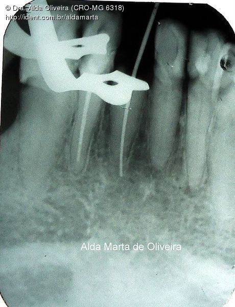 Odontogeriatria: Gengivectomia, Endo do 41 Calcificado, Pino em Fibra ...