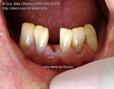 Odontogeriatria: Gengivectomia, Endo do 41 Calcificado, Pino em Fibra ...