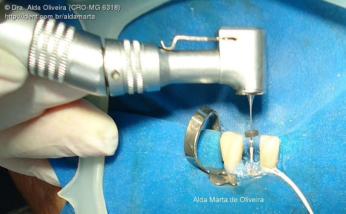 Odontogeriatria: Gengivectomia, Endo do 41 Calcificado, Pino em Fibra ...