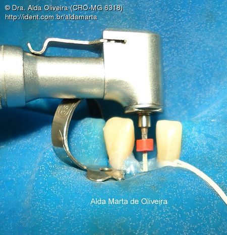 Odontogeriatria: Gengivectomia, Endo do 41 Calcificado, Pino em Fibra ...