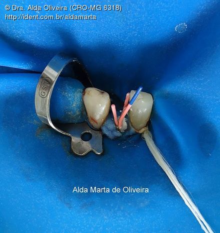 Odontogeriatria: Gengivectomia, Endo do 41 Calcificado, Pino em Fibra ...