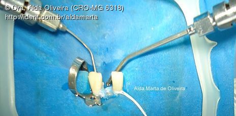 Odontogeriatria: Gengivectomia, Endo do 41 Calcificado, Pino em Fibra ...