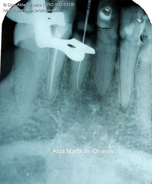 Odontogeriatria: Gengivectomia, Endo do 41 Calcificado, Pino em Fibra ...