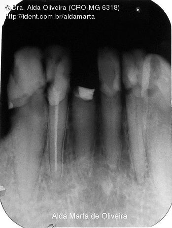 Odontogeriatria: Gengivectomia, Endo do 41 Calcificado, Pino em Fibra ...