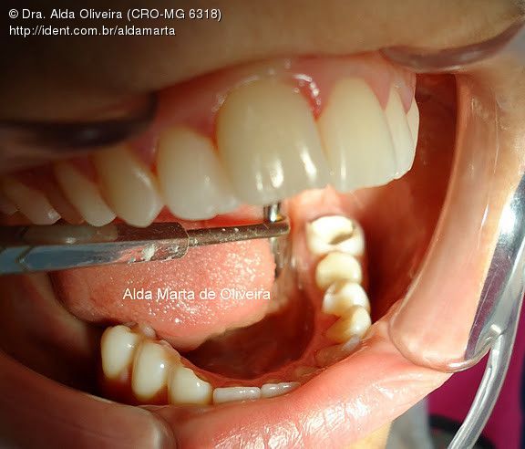 Endocrown no Dente 37, Caso clínico | iDent