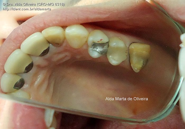 Endo, Pino, Np e Onlay no 16., Caso clínico | iDent