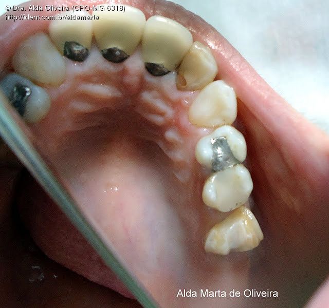 Endo, Pino, Np e Onlay no 16., Caso clínico | iDent