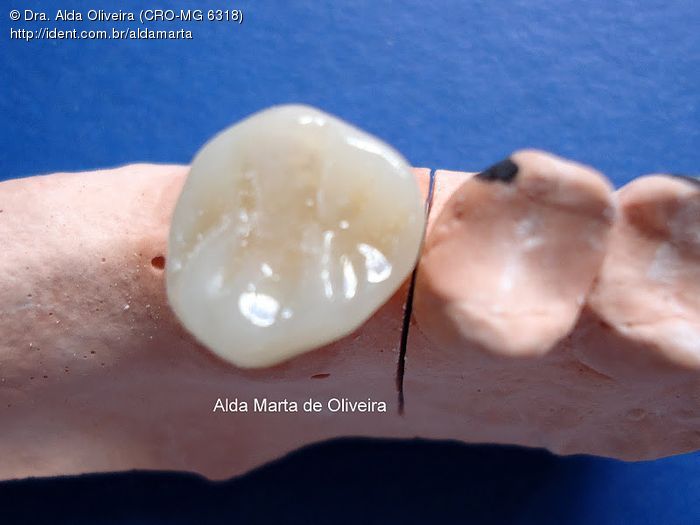 Endo, Pino, Np e Onlay no 16., Caso clínico | iDent