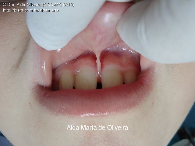Frenectomia Labial Superior, Caso clínico | iDent