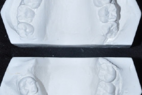 Exérese de 3º Molar Semi-Incluso, Caso clínico | iDent