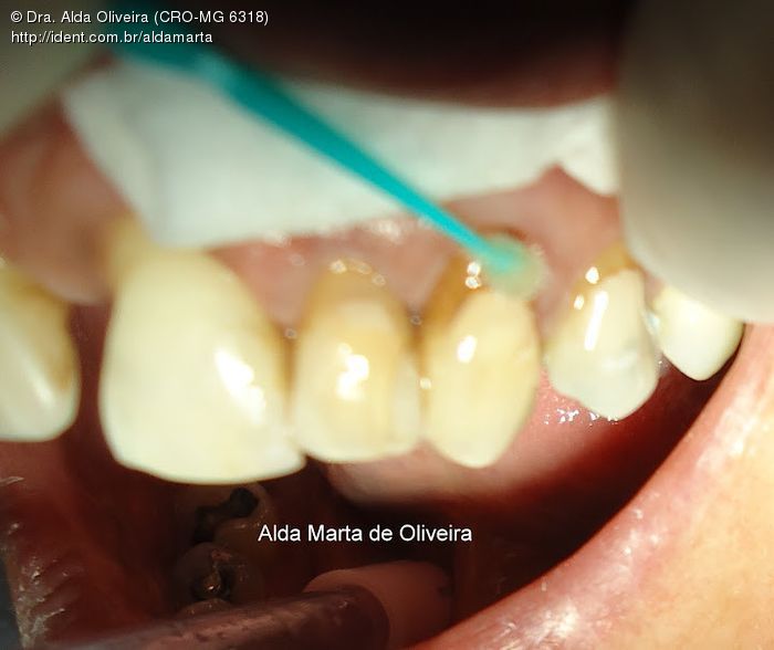 Restaurações de Abfrações, Caso clínico | iDent