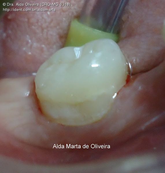 Endocrown em Cerômero (Art Glass) no Elemento 47., Caso clínico | iDent
