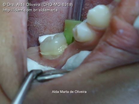 Endocrown em Cerômero (Art Glass) no Elemento 47., Caso clínico | iDent