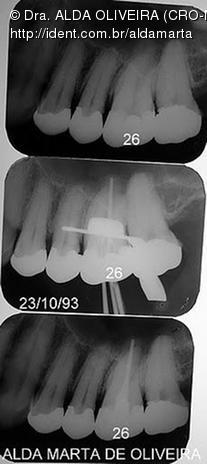Tratamento Endodôntico Dente 26 com Calcificação dos Condutos ...