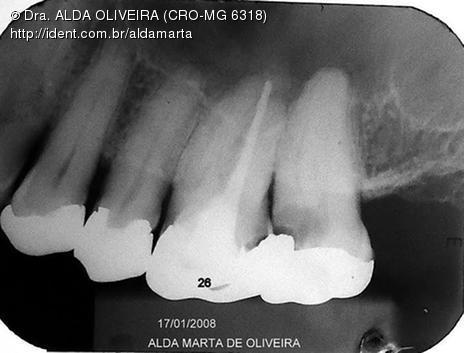 Tratamento Endodôntico Dente 26 com Calcificação dos Condutos ...
