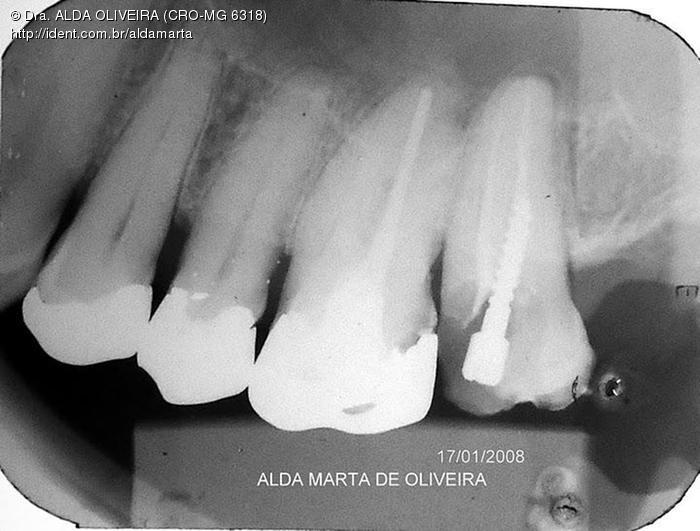 Tratamento Endodôntico Dente 26 com Calcificação dos Condutos ...