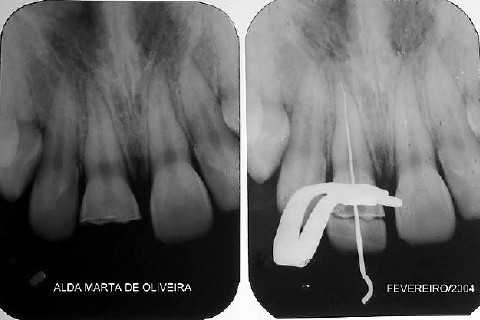 Tratamento Endodôntico Dente 26 com Calcificação dos Condutos ...