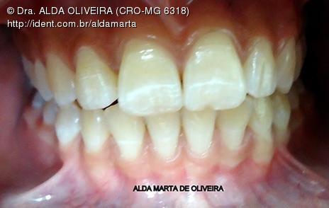 Fluorose, Caso clínico | iDent