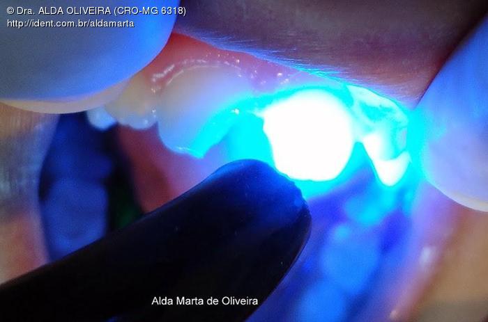 Traumatismo e Fratura dos Ângulos dos 11 e 21 com Rizogênese Incompleta ...