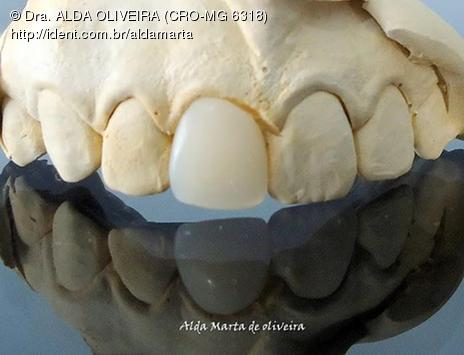 Coroa em Cerômero no 11, Caso clínico | iDent