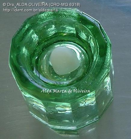 Coroa em Cerômero no 11, Caso clínico | iDent