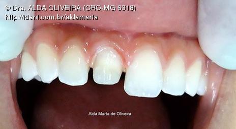 Coroa em Cerômero no 11, Caso clínico | iDent
