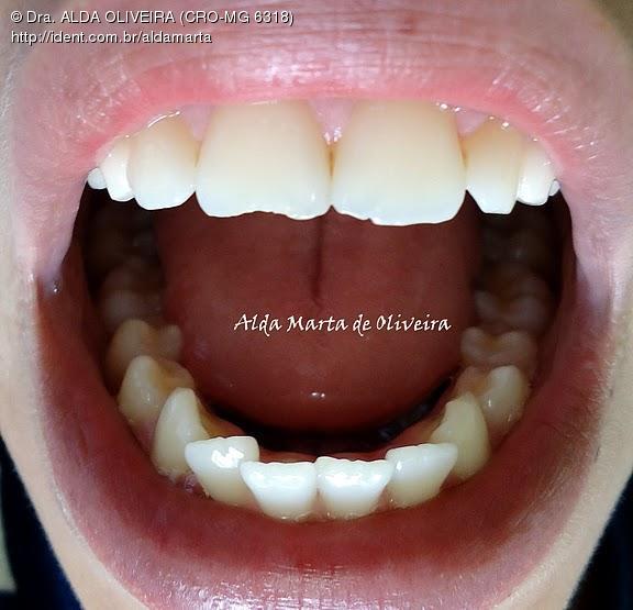 Devolvendo Bordo Incisal ao Dente 11, Caso clínico | iDent
