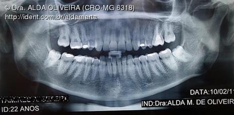 Cirurgia de Siso Incluso, Caso clínico | iDent