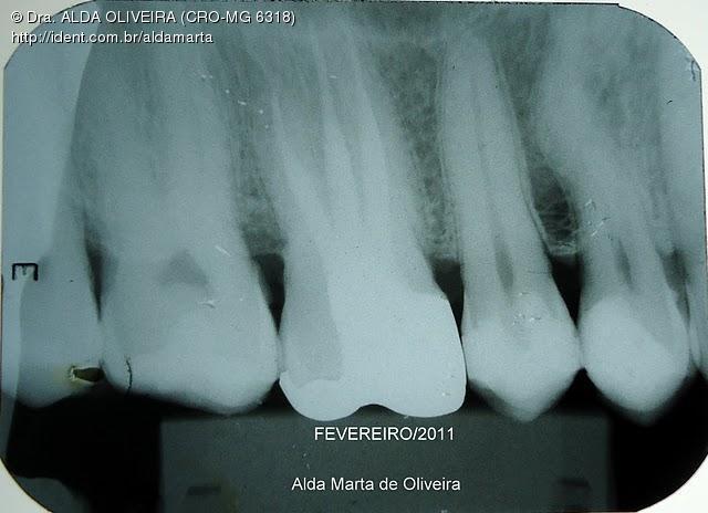 Retratamento Dente 26, Rmf e Proservação Após 12 Anos..., Caso clínico ...